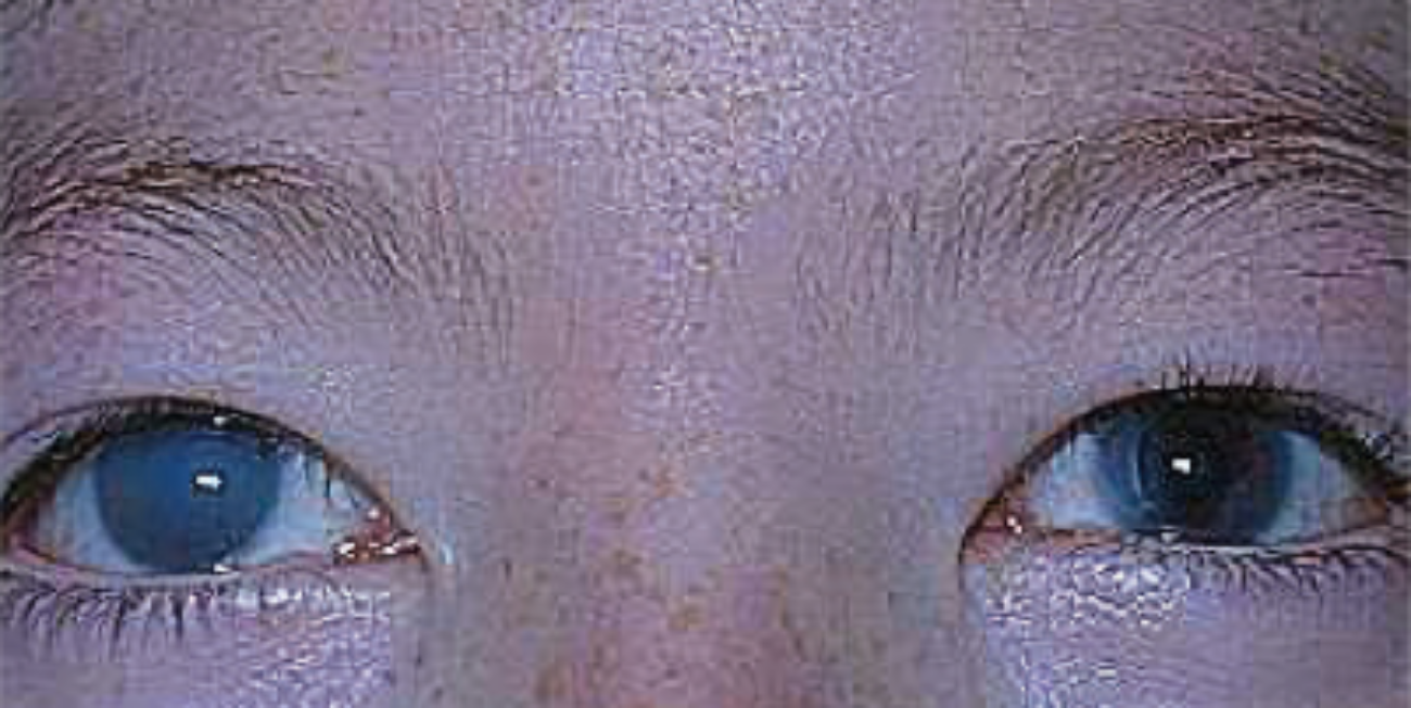 DIFFERENTIATING MPS I